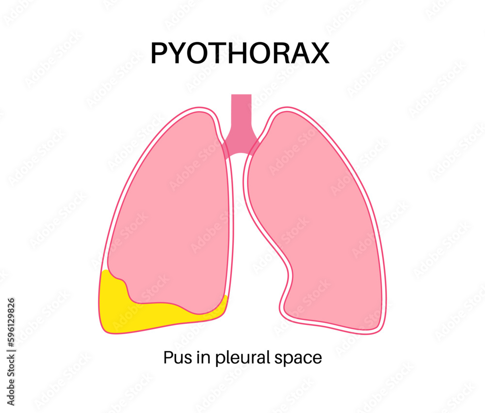 Pyothorax pleural empyema Stock Vector | Adobe Stock