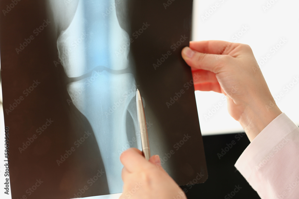 Female doctor looks at x-ray of knee injury in hospital. Sequelae of ...