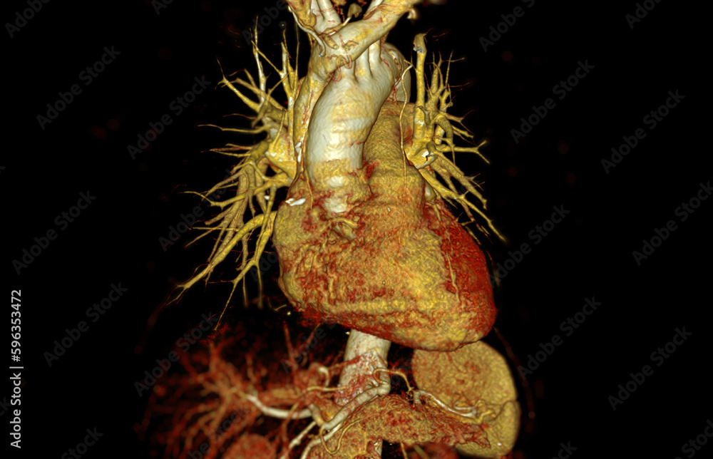 Poster CTA of the aorta with stent-grafting in patient Abdominal aortic ...