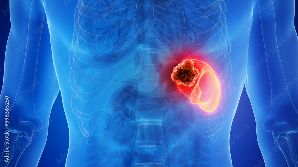 3D Rendered Medical Illustration of Male Anatomy - Splenic Cancer ...