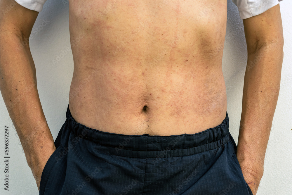 Itchy Body Rash Caused By Allergies On Middle Part Of Man Body Male Torso With Red Allergic