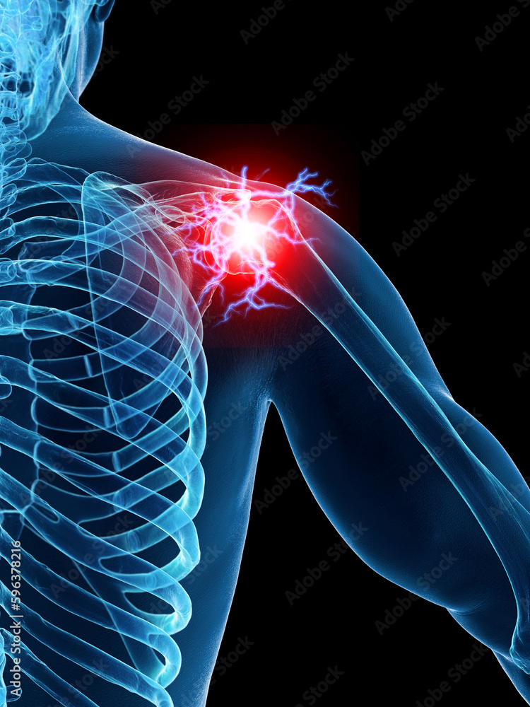 3d medical illustration of shoulder pain Stock Illustration | Adobe Stock