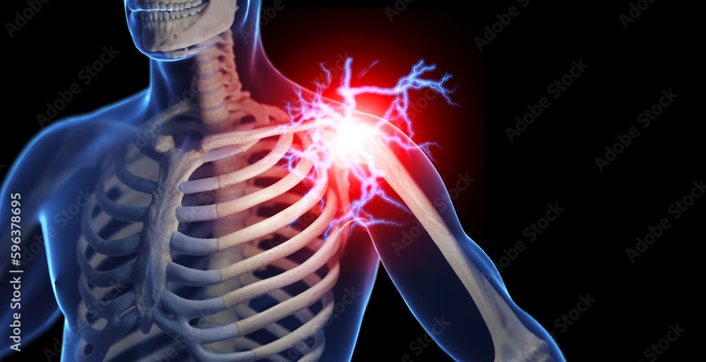3d medical illustration of shoulder pain Stock Illustration | Adobe Stock