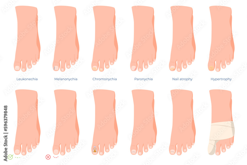 Ingrown toenails, diseases of the toes. Treatment and care of problem ...