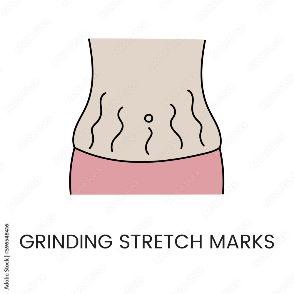 Resurfacing stretch marks on the skin with laser cosmetology, in vector ...