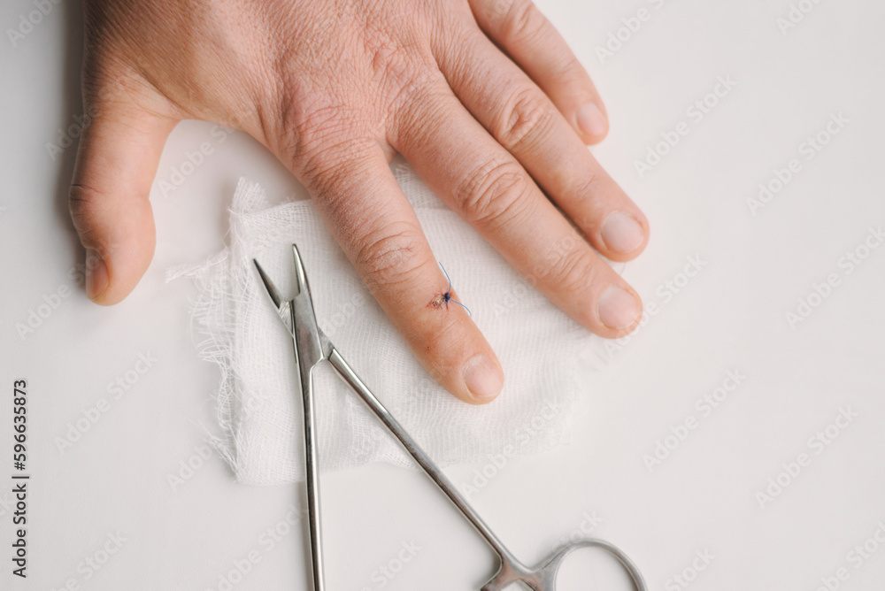 Removal of suture on finger of patient in clinic. Inspection of seam on ...