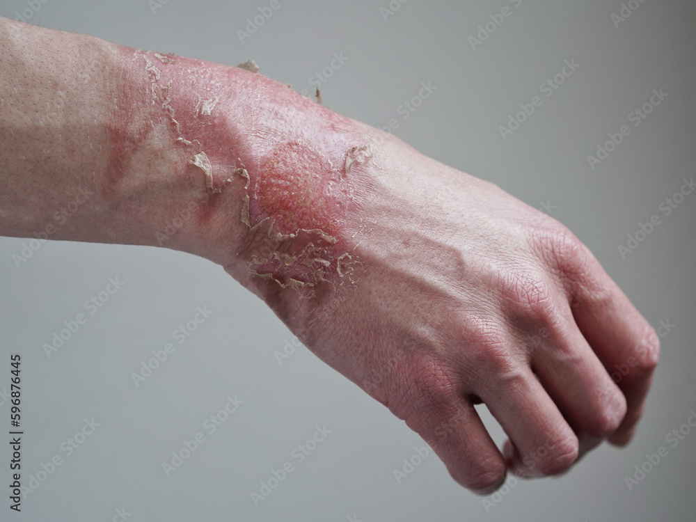 Close-up of a woman's hand with a burst blister from a boiled water ...
