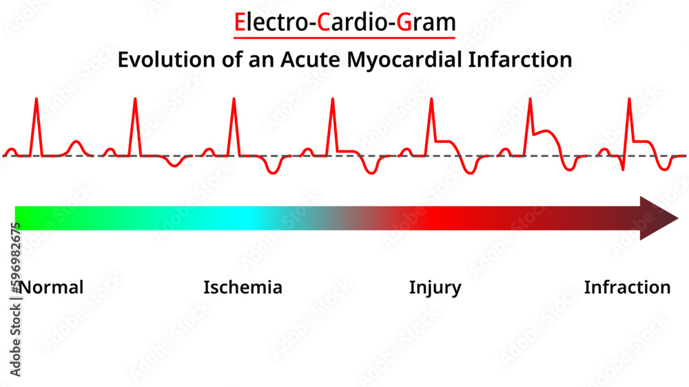 Evolution of an Acute Myocardial Infarction - Vectors and Illustrations ...