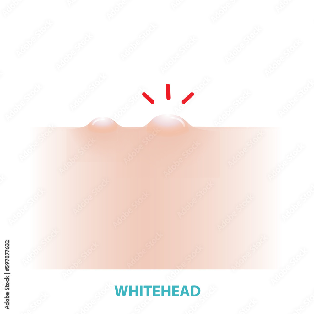 Whitehead acne vector illustration isolated on white background ...