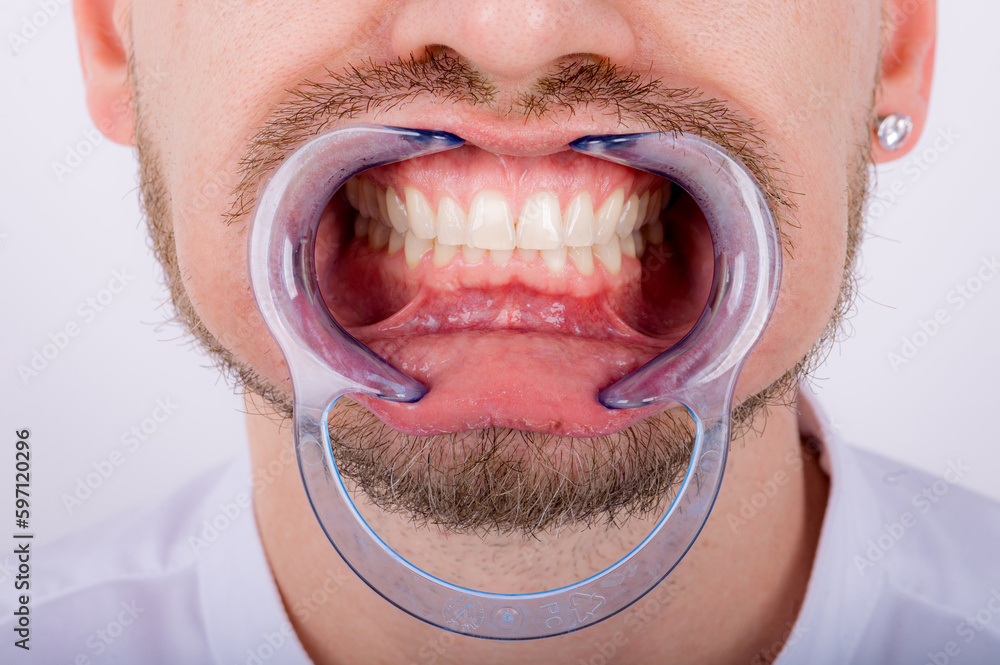 Man patient with retractor standing with open mouth in dental clinic ...