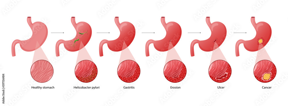Stomach diseases. Diagram of diseases of helicobacter pylori, gastritis ...