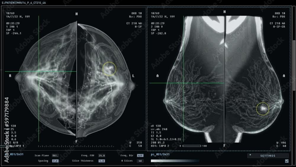 Screening checkup detecting the cancer growth in the woman's patient ...
