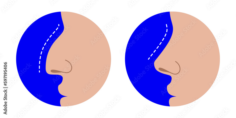Crooked and straight nose comparison, before and after rhinoplasty ...