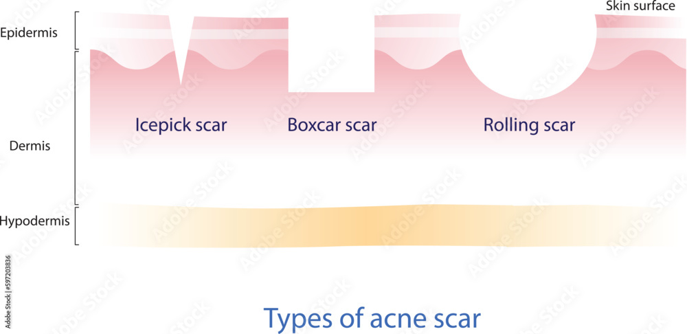 Types of acne scar vector on white background. Cross section of icepick ...