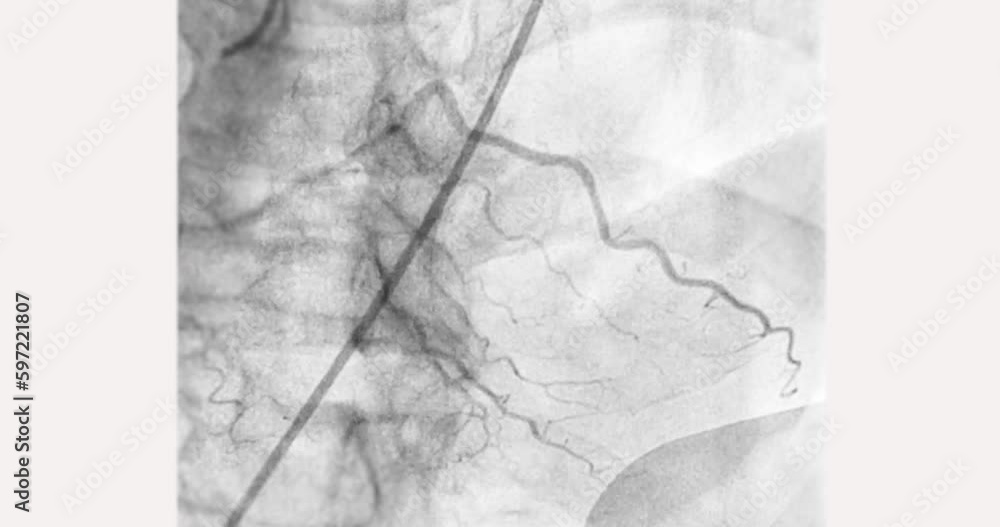 Cardiac catheterization showing coronary arteries used to diagnose and ...