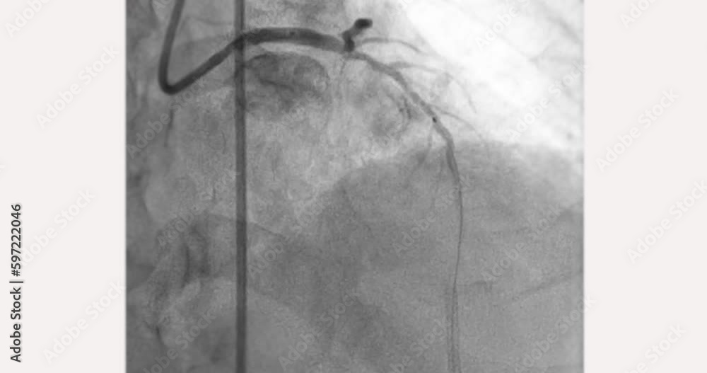 Cardiac catheterization showing coronary arteries used to diagnose and ...