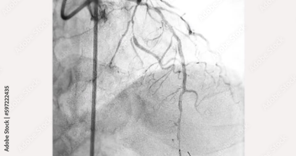Cardiac catheterization showing coronary arteries used to diagnose and ...