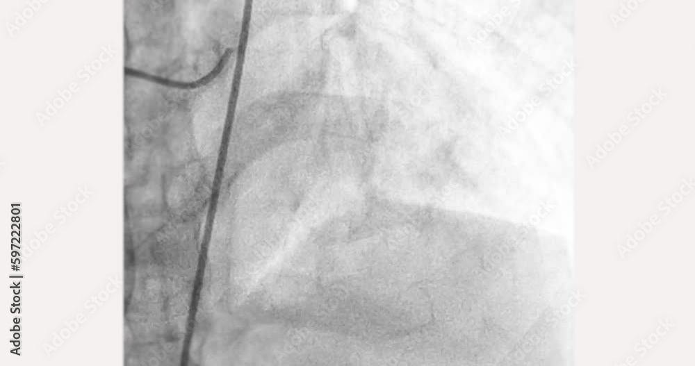 Cardiac catheterization showing coronary arteries used to diagnose and ...