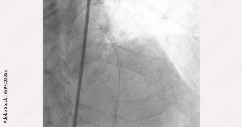 Cardiac catheterization showing coronary arteries used to diagnose and ...