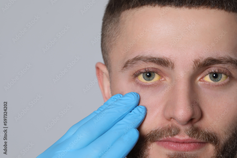 Doctor checking yellow eyes of patient on light grey background ...