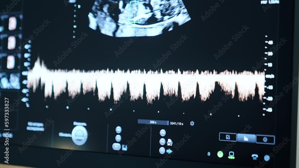 Screen of ultrasonic machine at work. Image of baby and life parameters ...