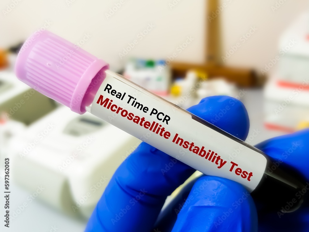 Microsatellite Instability (MSI) test,MSI screening is used to see the ...