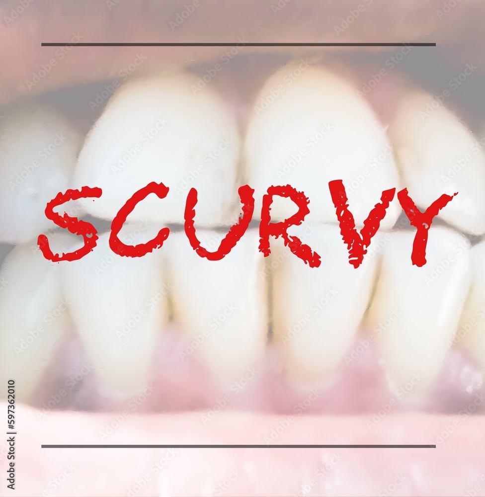 Scurvy, caused by severe vitamin C deficiency, health concept. Medical ...