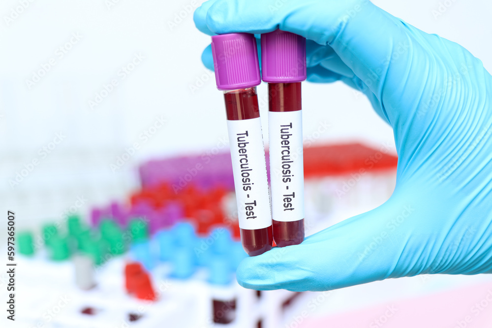 Tuberculosis test, blood sample to analyze in the laboratory Stock ...