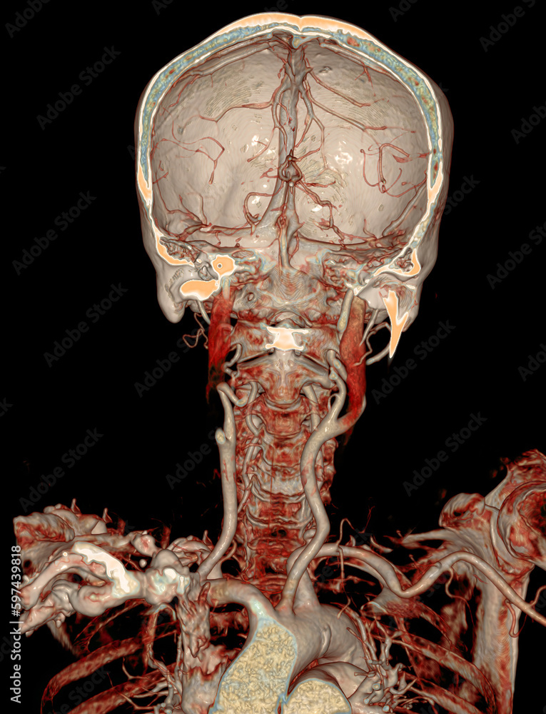 CTA brain and carotid artery or CT angiography of the brain 3D ...