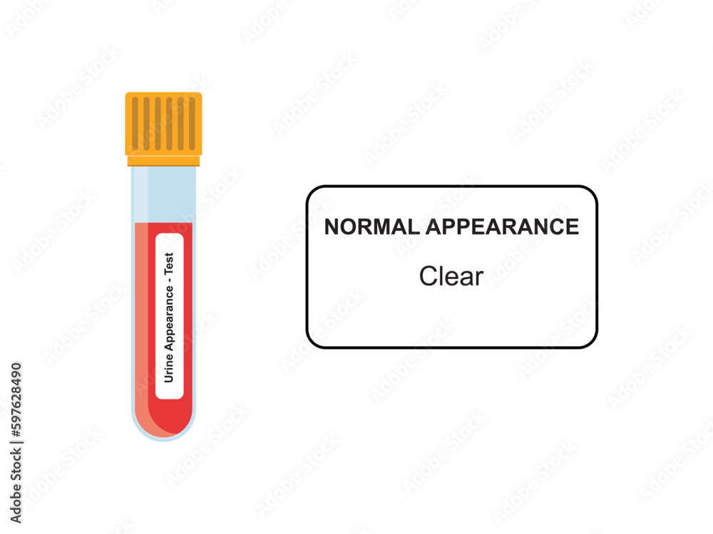 Urine Appearance Test Concept Design. Vector Illustration. Stock Vector ...