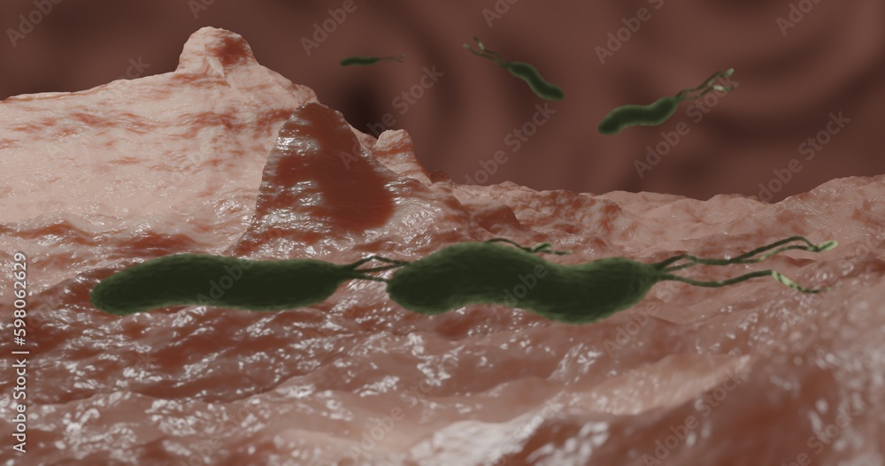 Helicobacter pylori or H. pylori, the bacillus of ulcer in 3D ...