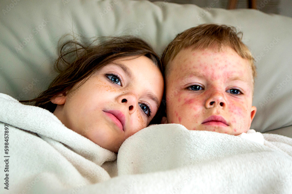 Natural vaccination between brother and sister. Contagious disease ...