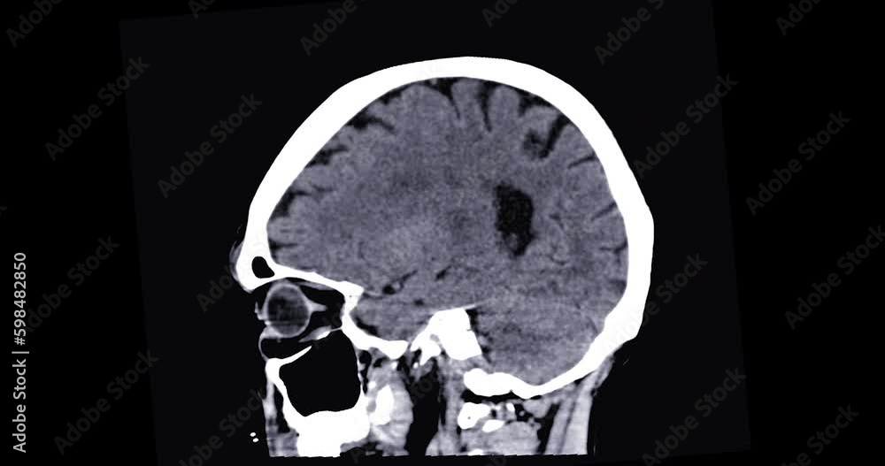 CT scan of the brain sagittal view for diagnosis brain tumor,stroke diseases and vascular ...