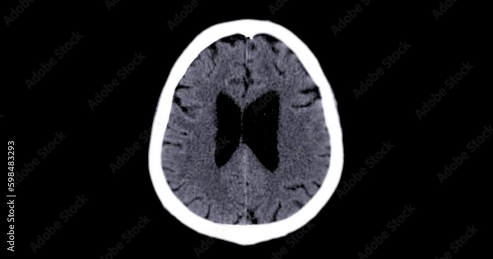 CT scan of the brain Axial view for diagnosis brain tumor,stroke diseases and vascular diseases ...