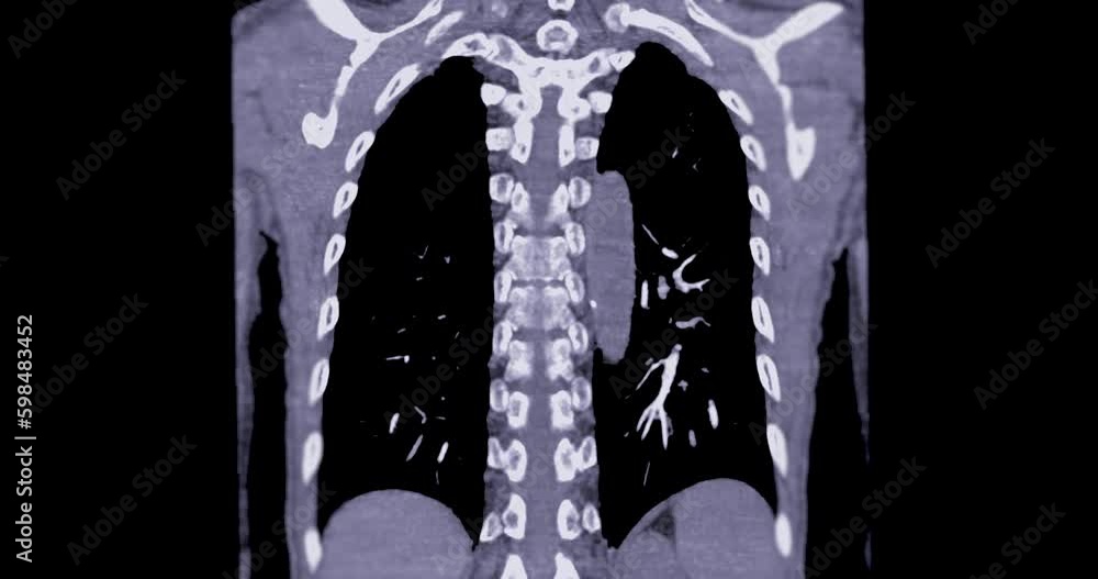 CT Chest or CT Scan of Lung with lung filter for diagnosis TB,tuberculosis and coronavirus or ...