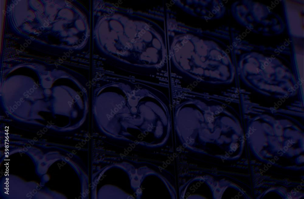 Computed tomography (CT scan) of chest with abdomen, just like visible ...