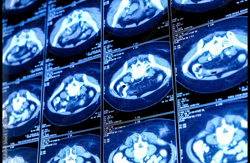 Computed tomography (CT scan) of chest with abdomen, just like visible ...