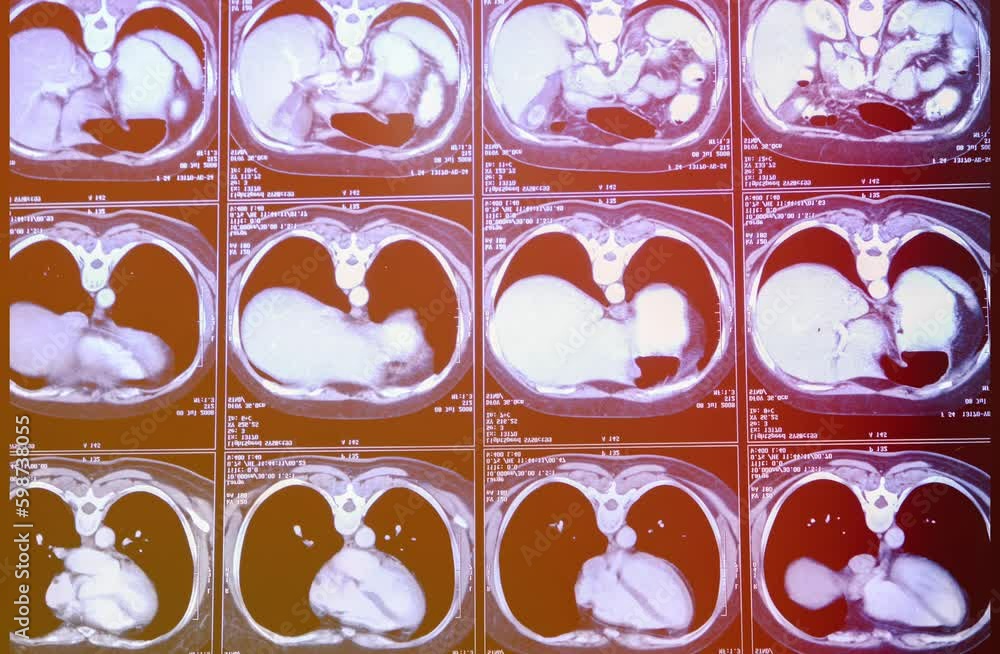 Computed tomography (CT scan) of chest with abdomen, just like visible ...