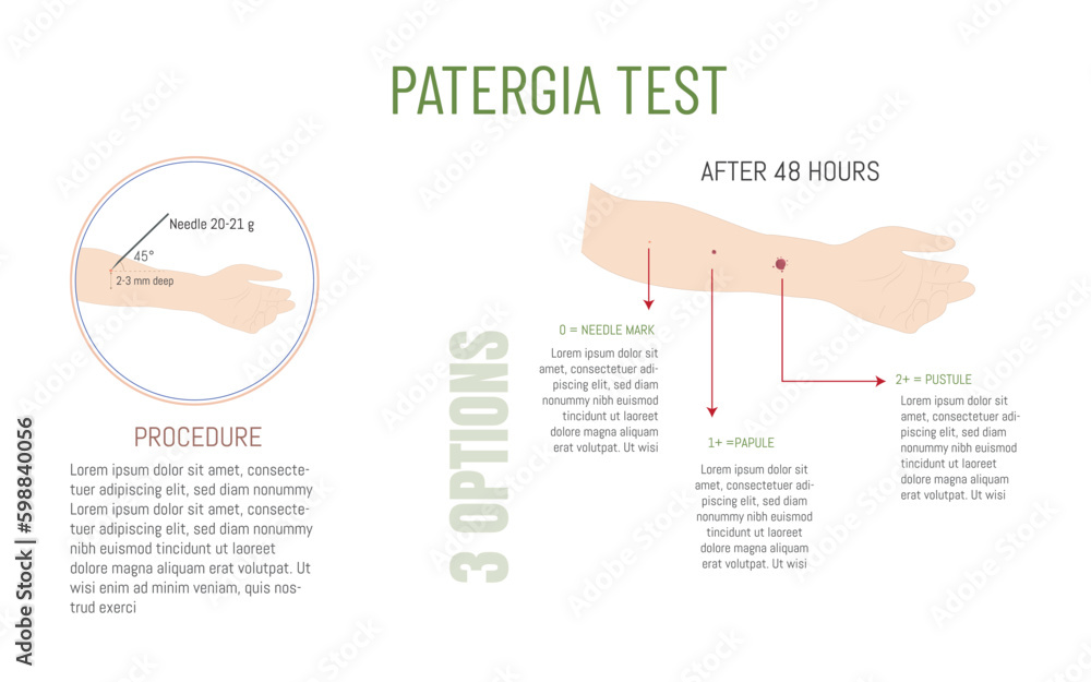 Infographic explaining the Patergia test to detect Behçet's disease ...