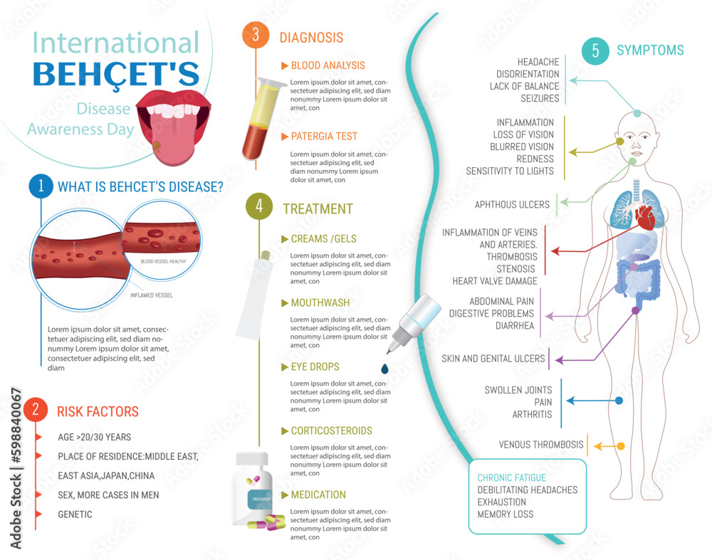 Infographic of Behçet's disease, symptoms, causes, risk factors and ...