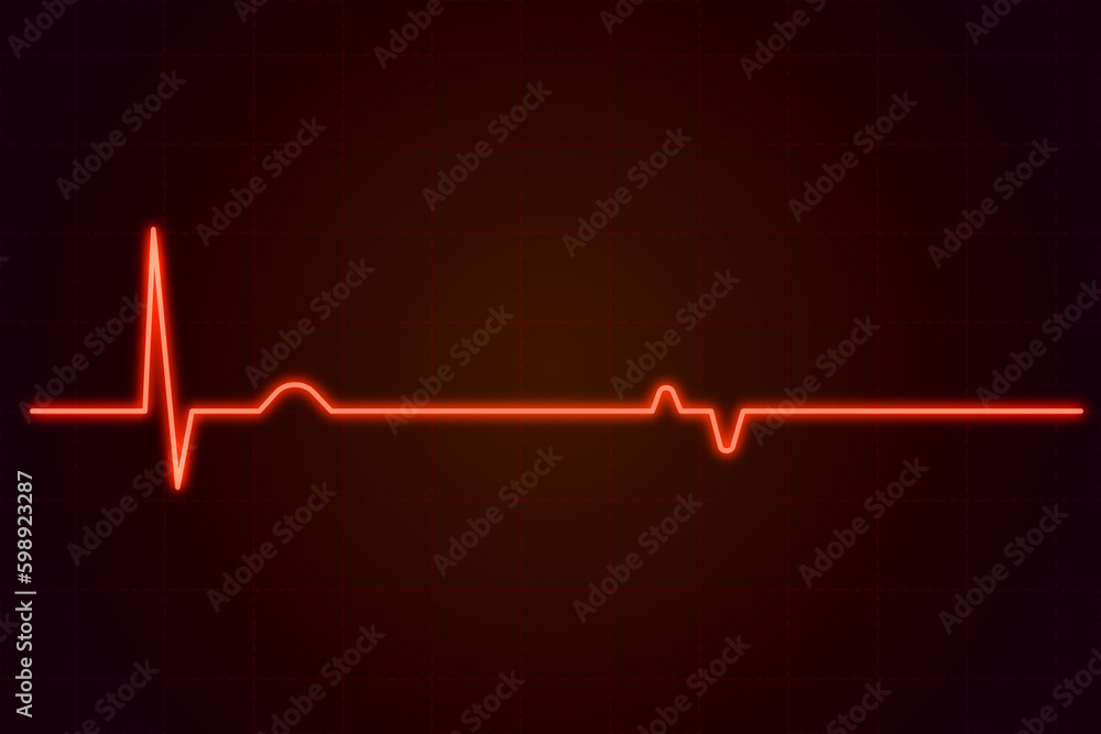 EKG monitor in intra aortic balloon pump machine in icu on blur ...