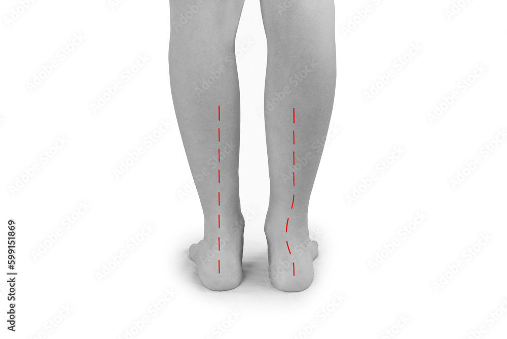 Feet Of A Teenager With Flat Feet Or A Dropped Arch With The Ankle Tilted Inward A Line