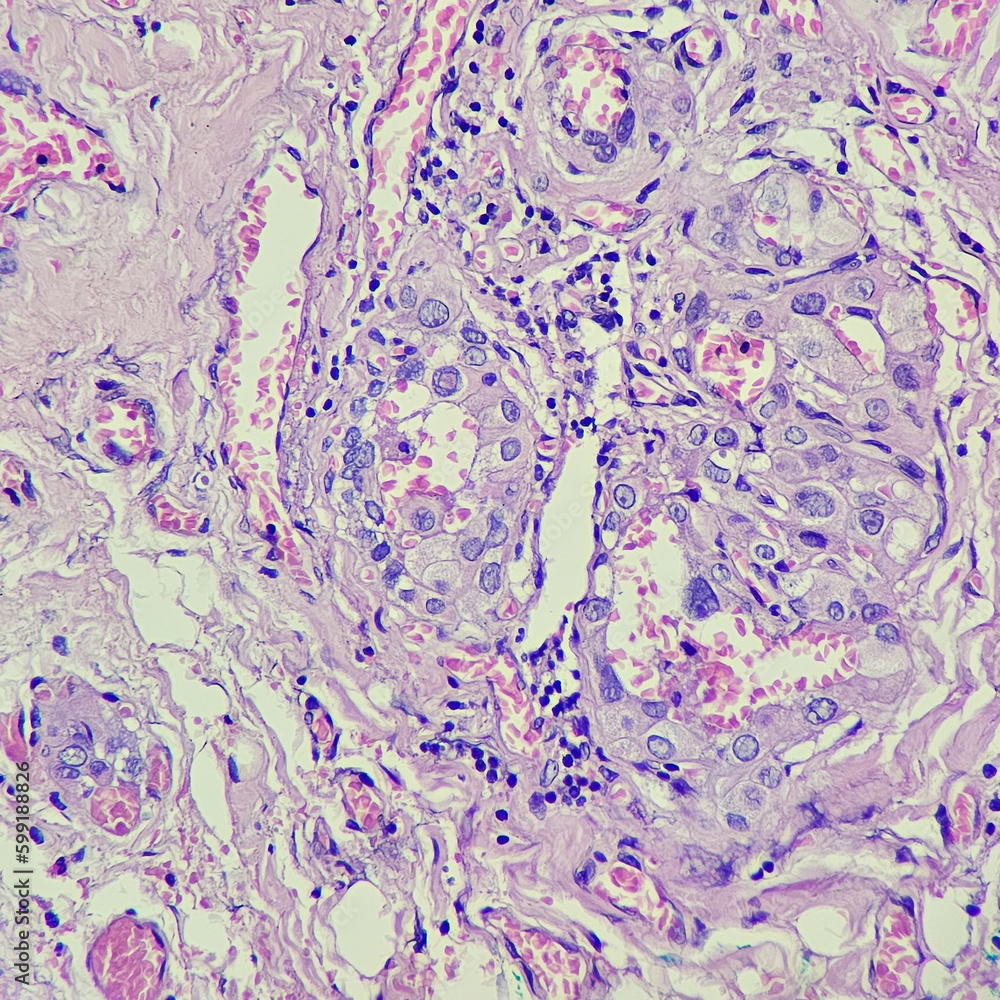 Camera photo of papillary thyroid carcinoma, showing characteristic ...