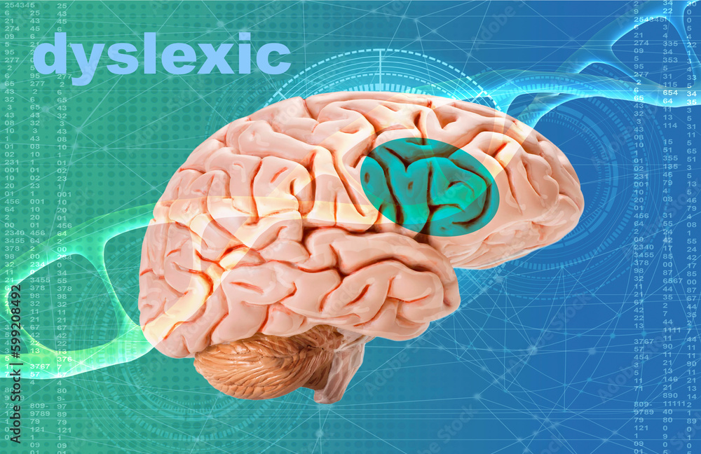 Neural Signature in human brain for Dyslexia, Disruption of Posterior Reading System, dyslexic ...