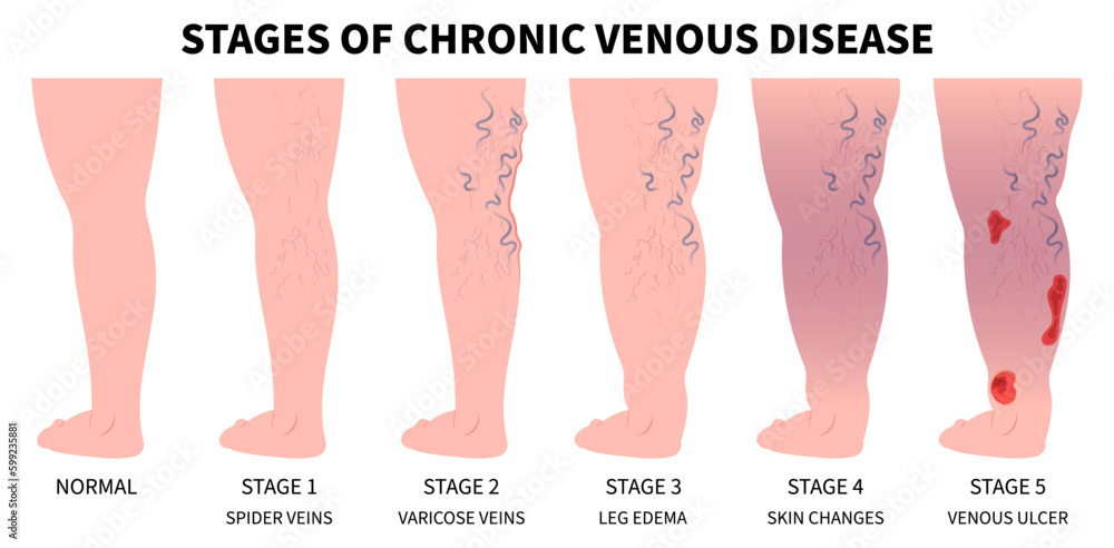 Vascular Artery Disease Medical Anatomy Varicose Vein Phlebectomy or ...
