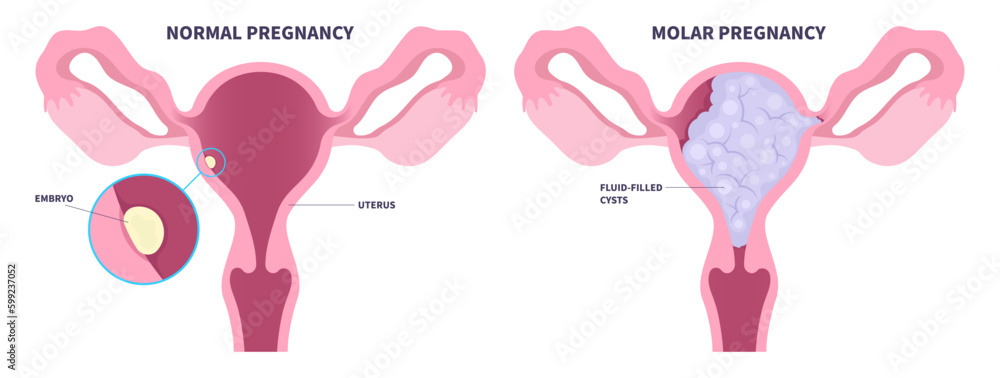 Vetor de Molar pregnancy or Hydatidiform mole trophoblasts disease ectopic fetus placenta ...