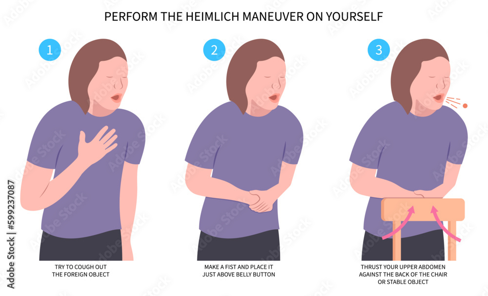 Heimlich maneuver for Choking first aid baby food CPR child step lodges blocking victim adult ...