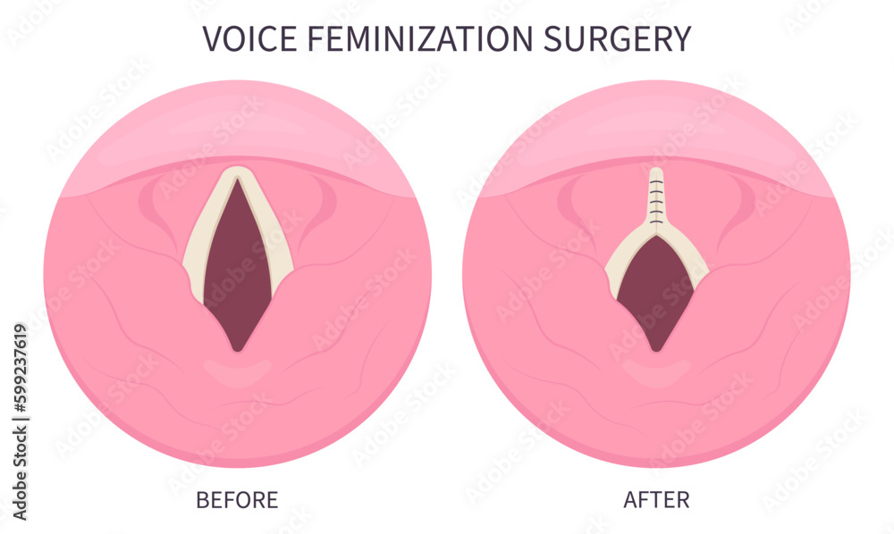 Voice Feminization Surgery male to female of Adam's procedure face ...