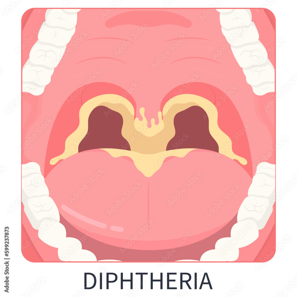 throat bacterial Diphtheria vaccine of group A with the tetanus croup ...