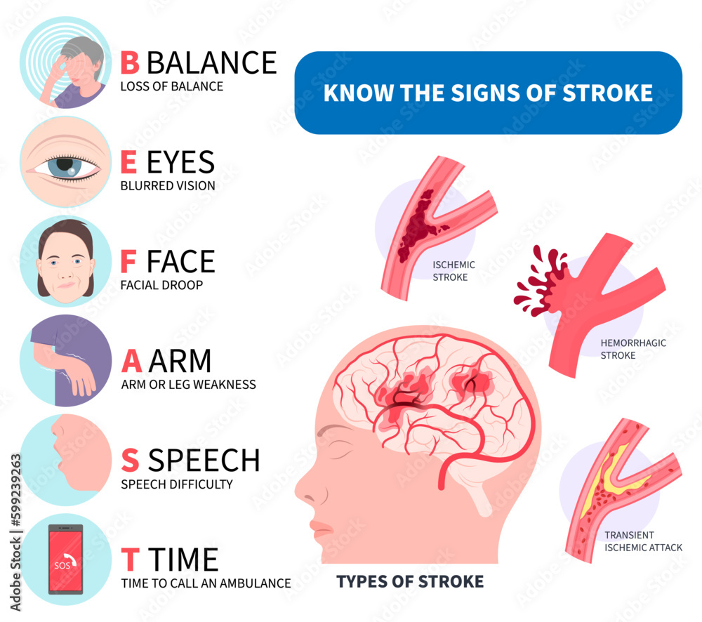 Brain Hemorrhagic Stroke attack damage frontal lobe of vascular ...